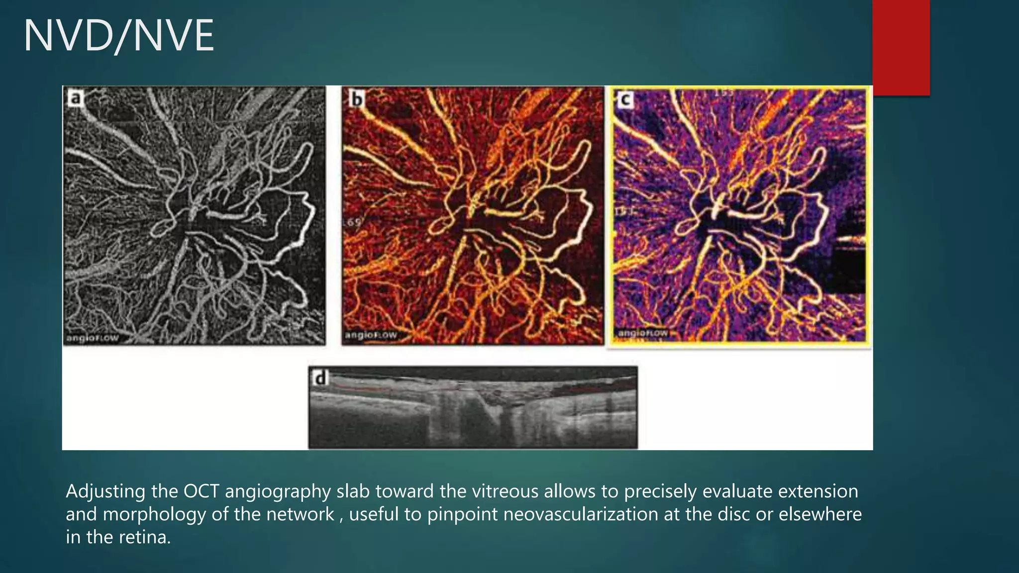 OCT Angiography | PPTX