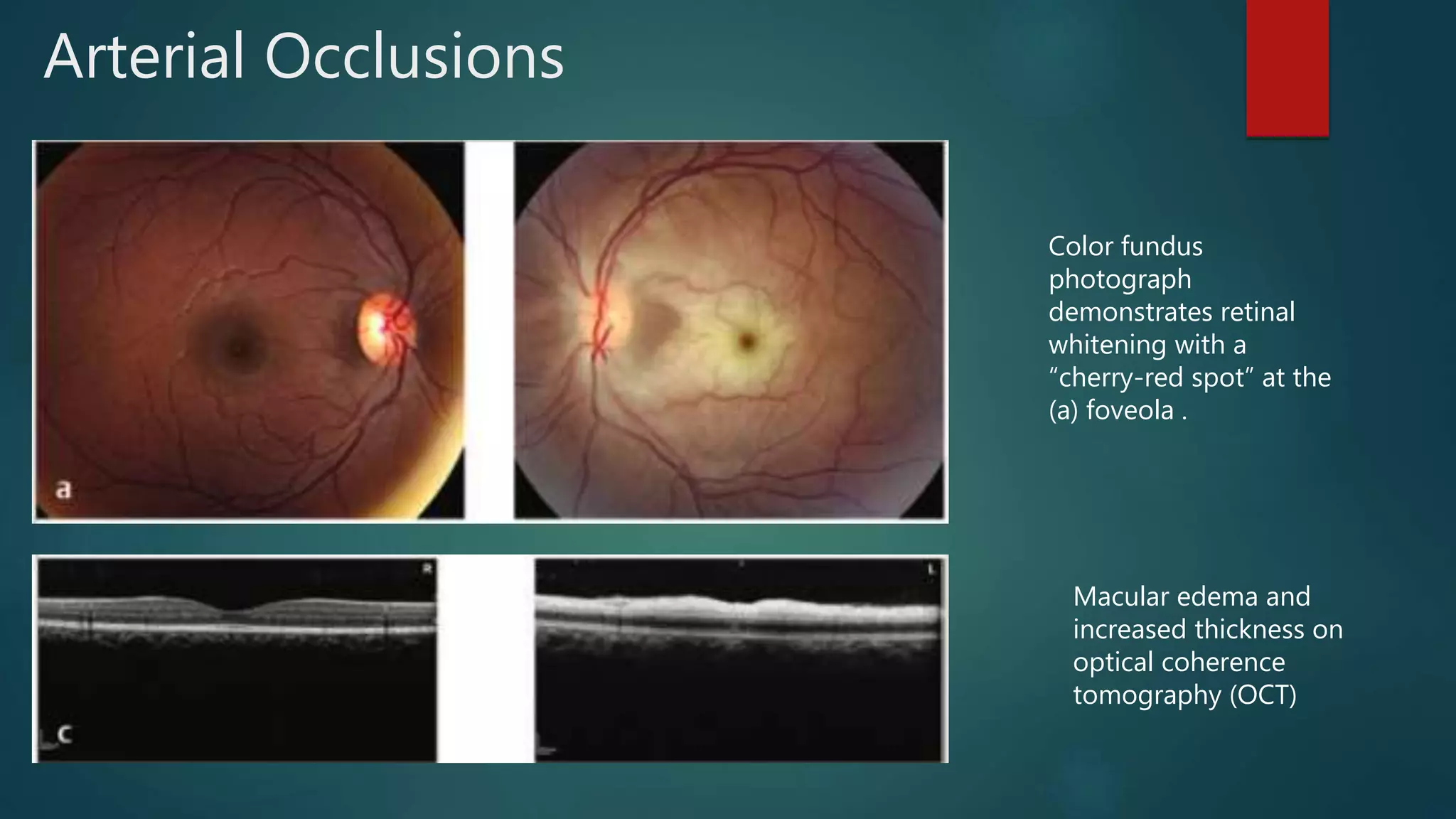OCT Angiography | PPTX