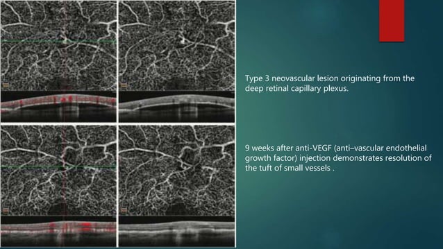 OCT Angiography | PPTX