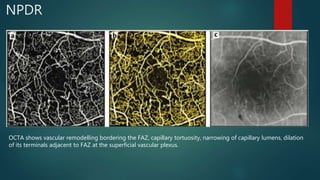 OCT Angiography | PPTX