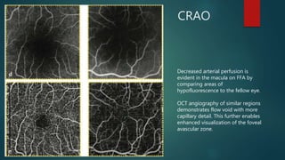 OCT Angiography | PPTX