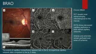 OCT Angiography | PPTX