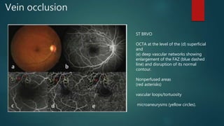 OCT Angiography | PPTX