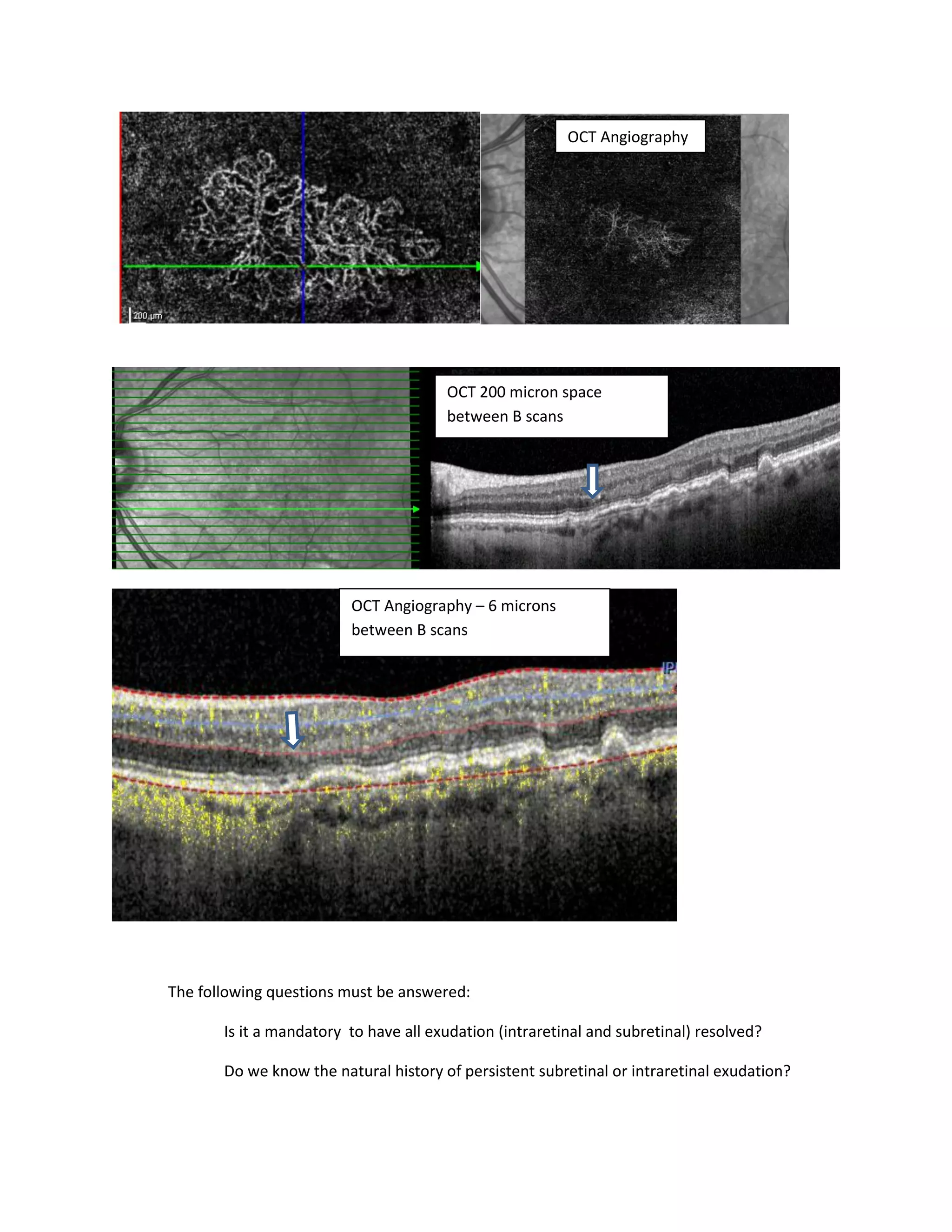 OCT Angiography - Sustaining Innovation | PDF