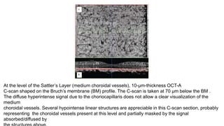 OPTICAL COHERENCE TOMOGRAPHY ANGIOGRAPHY | PPTX