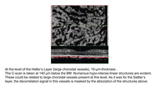 OPTICAL COHERENCE TOMOGRAPHY ANGIOGRAPHY | PPTX