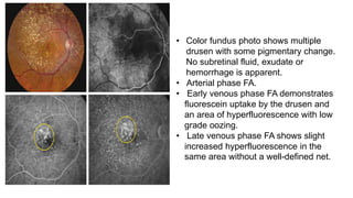 OPTICAL COHERENCE TOMOGRAPHY ANGIOGRAPHY | PPTX