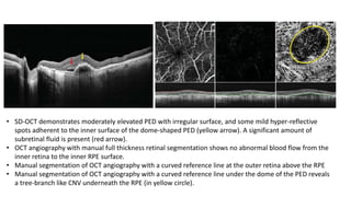 OPTICAL COHERENCE TOMOGRAPHY ANGIOGRAPHY | PPTX