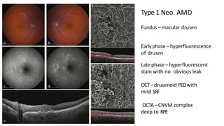 OPTICAL COHERENCE TOMOGRAPHY ANGIOGRAPHY | PPTX