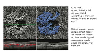 OPTICAL COHERENCE TOMOGRAPHY ANGIOGRAPHY | PPTX