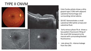 OPTICAL COHERENCE TOMOGRAPHY ANGIOGRAPHY | PPTX