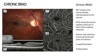 OPTICAL COHERENCE TOMOGRAPHY ANGIOGRAPHY | PPTX