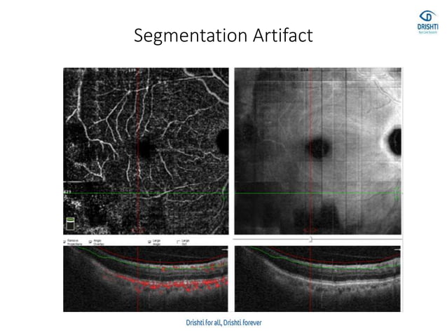 ABC of Oct and octa | PPTX | Eye and Vision Conditions | Diseases and ...