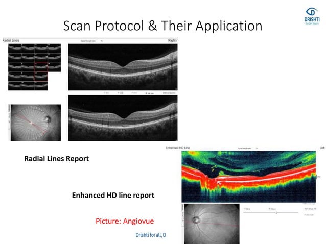 ABC of Oct and octa | PPTX | Eye and Vision Conditions | Diseases and ...