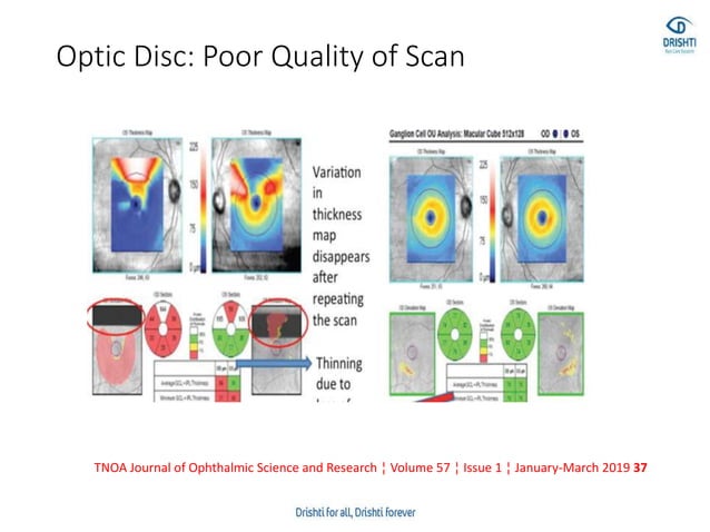 ABC of Oct and octa | PPTX | Eye and Vision Conditions | Diseases and ...