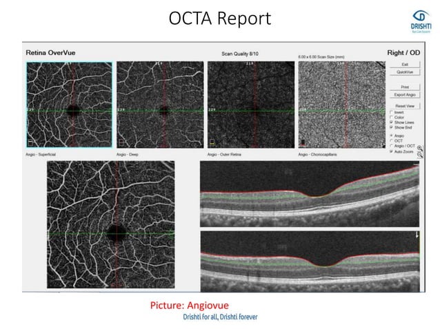 ABC of Oct and octa | PPTX | Eye and Vision Conditions | Diseases and ...