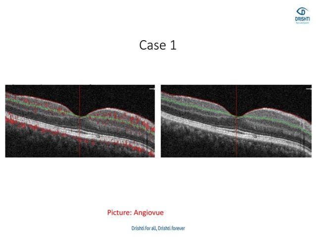 ABC of Oct and octa | PPTX | Eye and Vision Conditions | Diseases and ...