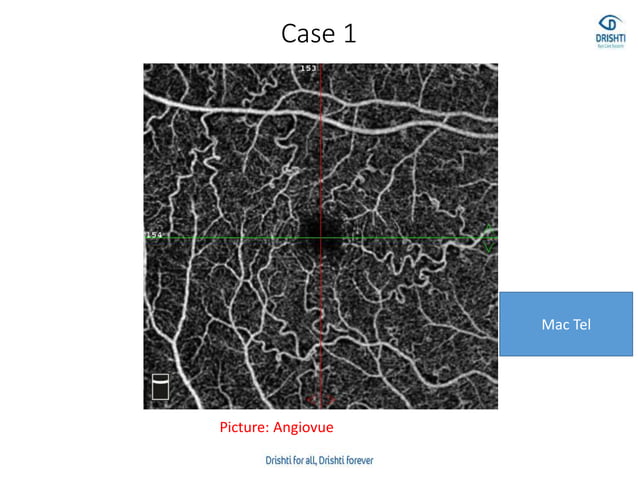 ABC of Oct and octa | PPTX | Eye and Vision Conditions | Diseases and ...