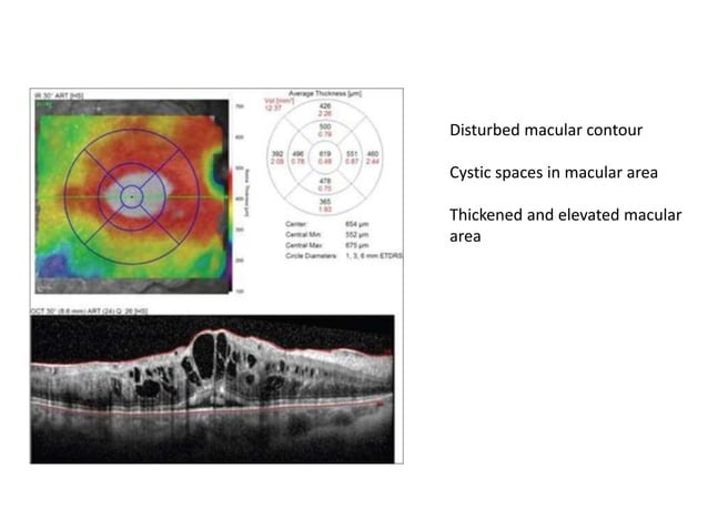 OCT AND VF cases.pptx