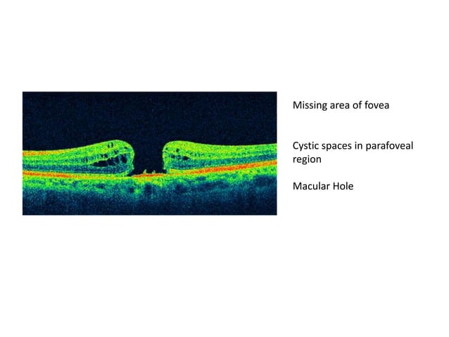OCT AND VF cases.pptx