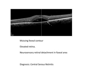 OCT AND VF cases.pptx