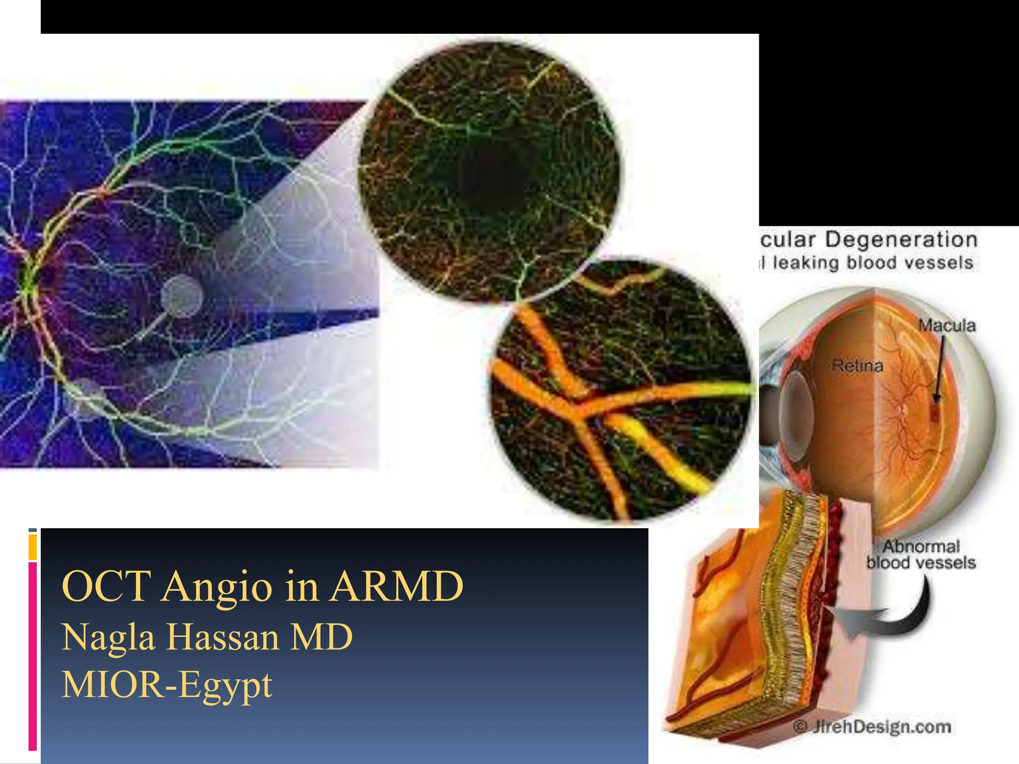 OCT ango in ARMD and telangictasia.pptx