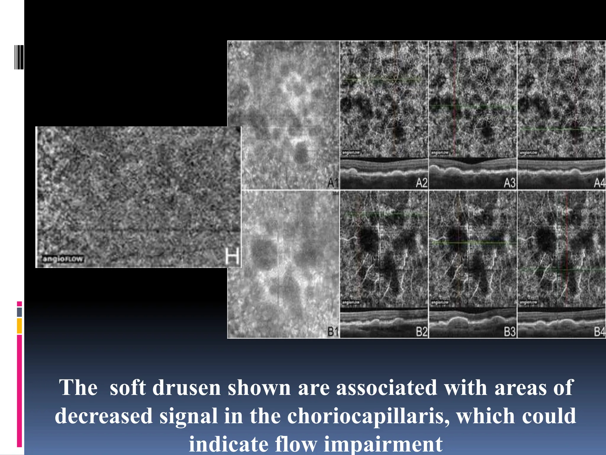 OCT ango in ARMD and telangictasia.pptx