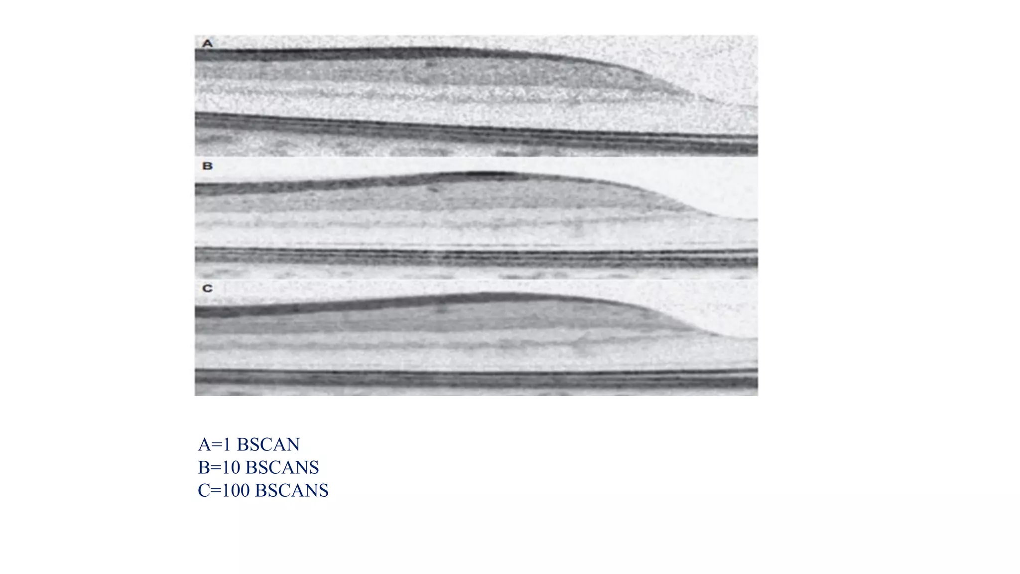 OCT MACULA INTERPRETATION. | PPTX