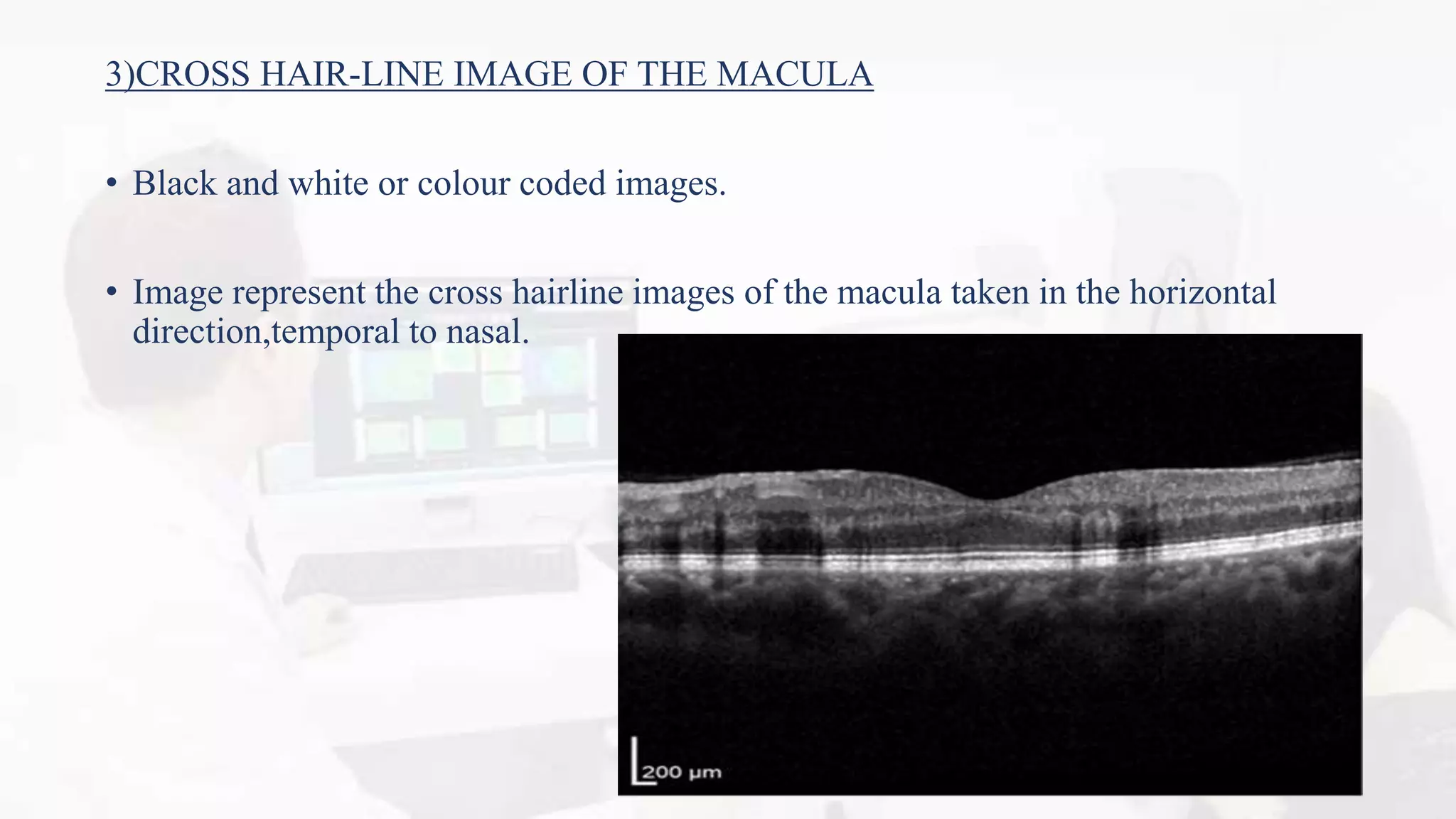 OCT MACULA INTERPRETATION. | PPTX