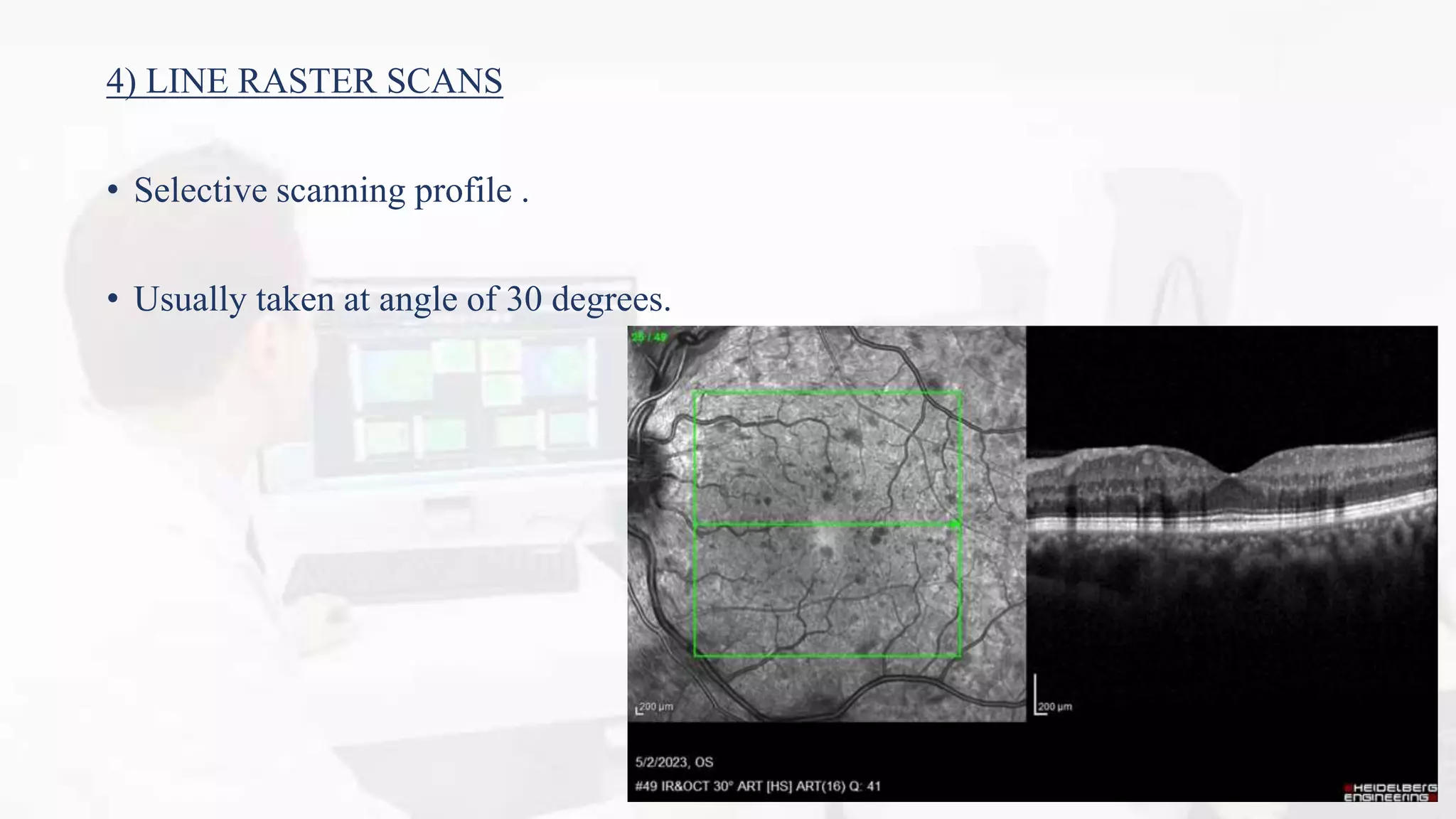 OCT MACULA INTERPRETATION. | PPTX