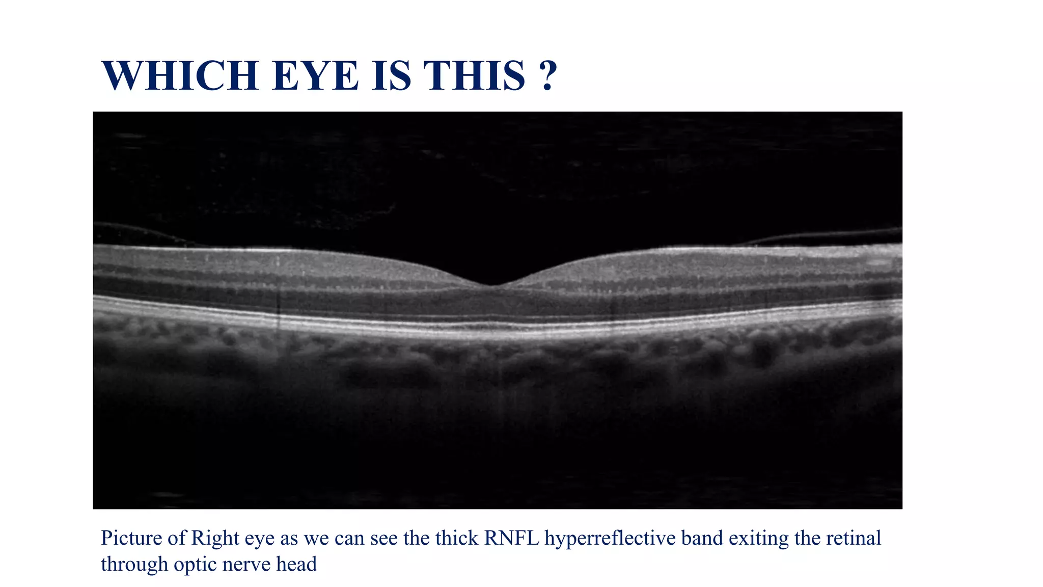 OCT MACULA INTERPRETATION. | PPTX