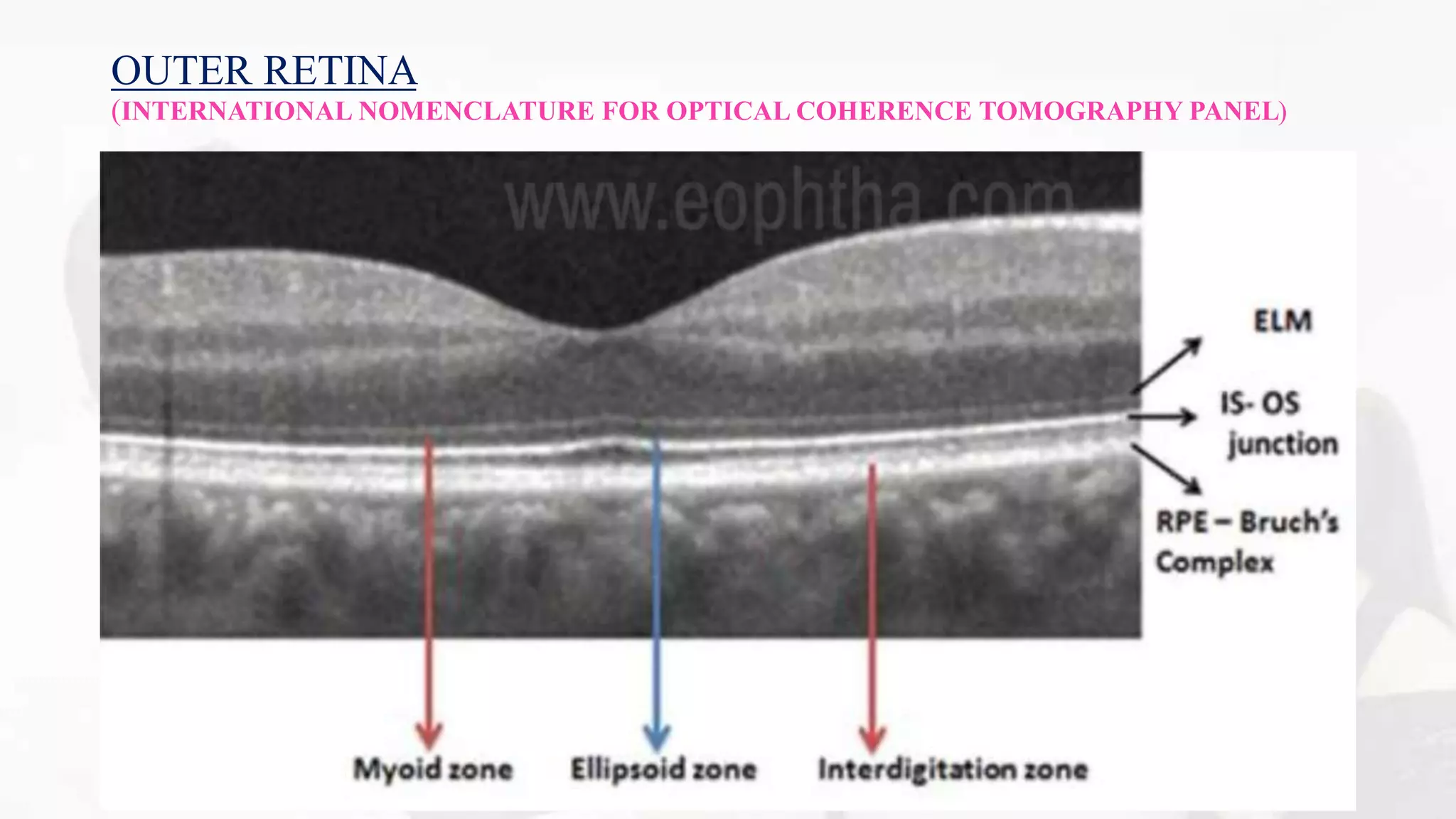 OCT MACULA INTERPRETATION. | PPTX