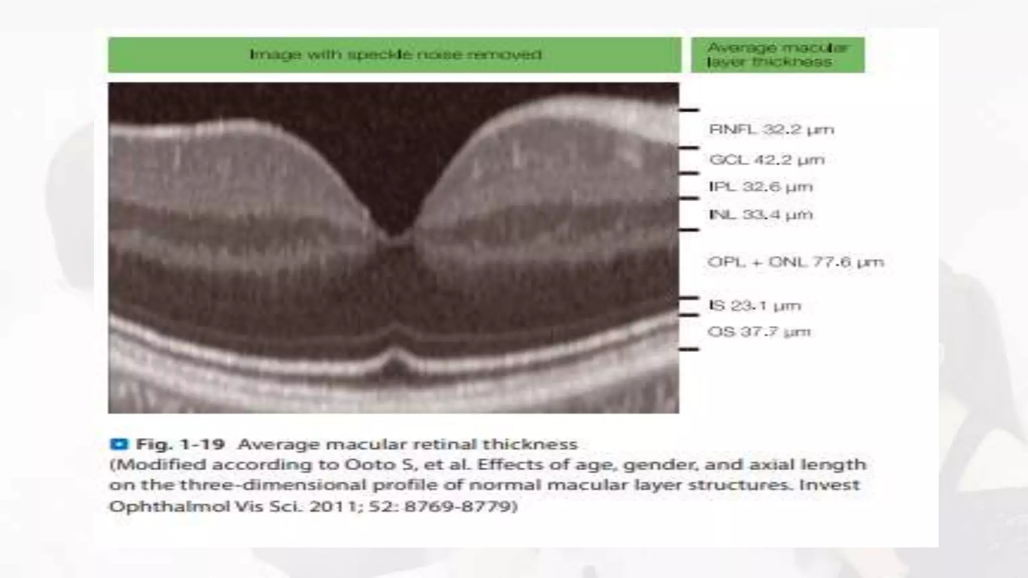 OCT MACULA INTERPRETATION. | PPTX