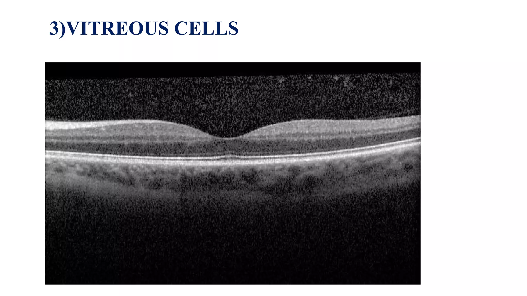 OCT MACULA INTERPRETATION. | PPTX