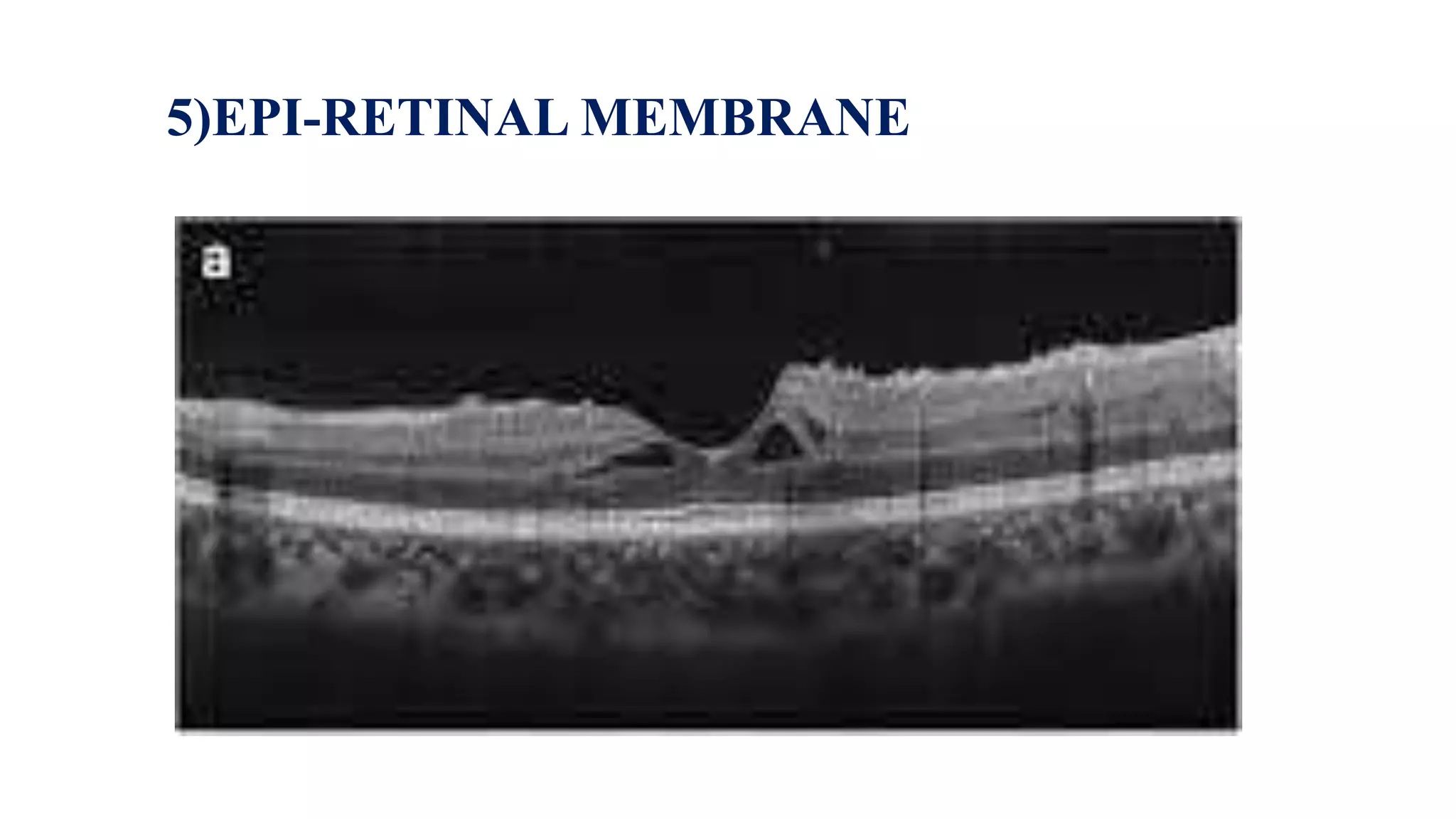 OCT MACULA INTERPRETATION. | PPTX