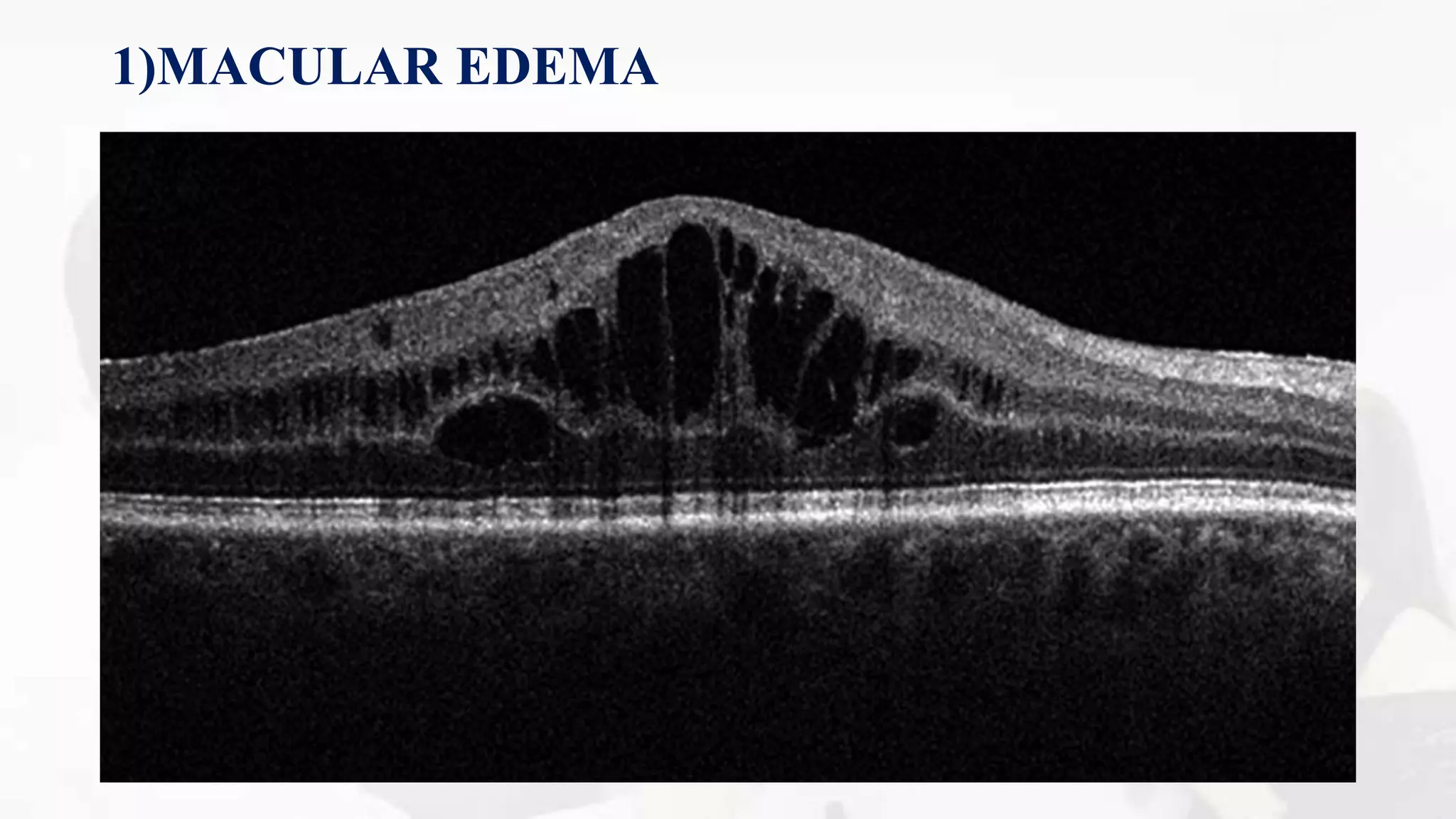 OCT MACULA INTERPRETATION. | PPTX