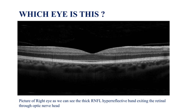 OCT MACULA INTERPRETATION. | PPTX