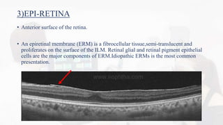 OCT MACULA INTERPRETATION. | PPTX