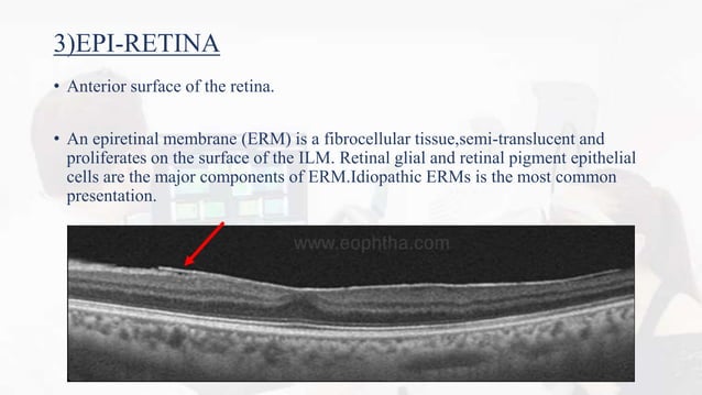 OCT MACULA INTERPRETATION. | PPTX