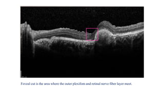 OCT MACULA INTERPRETATION. | PPTX