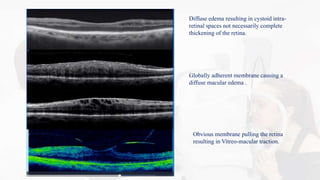 OCT MACULA INTERPRETATION. | PPTX