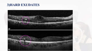 OCT MACULA INTERPRETATION. | PPTX
