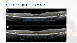 OCT MACULA INTERPRETATION. | PPTX
