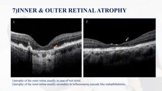 OCT MACULA INTERPRETATION. | PPTX