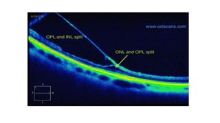 OCT MACULA INTERPRETATION. | PPTX