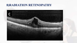 OCT MACULA INTERPRETATION. | PPTX