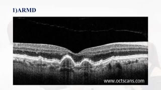 OCT MACULA INTERPRETATION. | PPTX