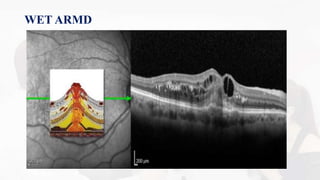 OCT MACULA INTERPRETATION. | PPTX