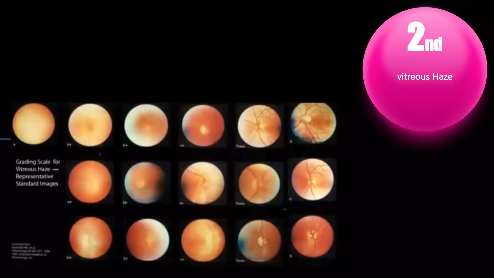 OCT biomarkers in uveitis.pptx | Free Download