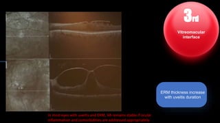 OCT biomarkers in uveitis.pptx